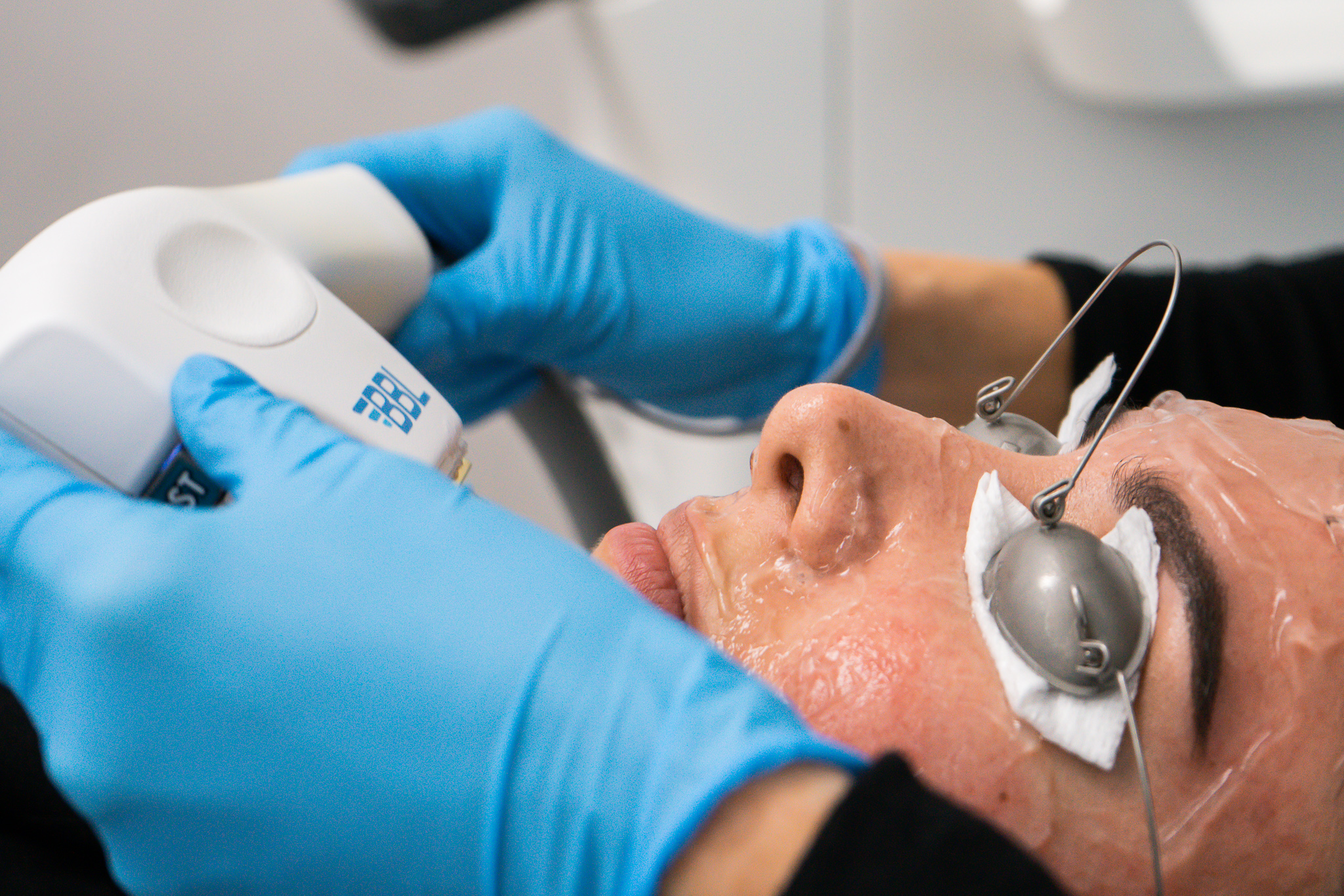 Anti-Aging Made Easy with BBL™ | Corrective Phototherapy