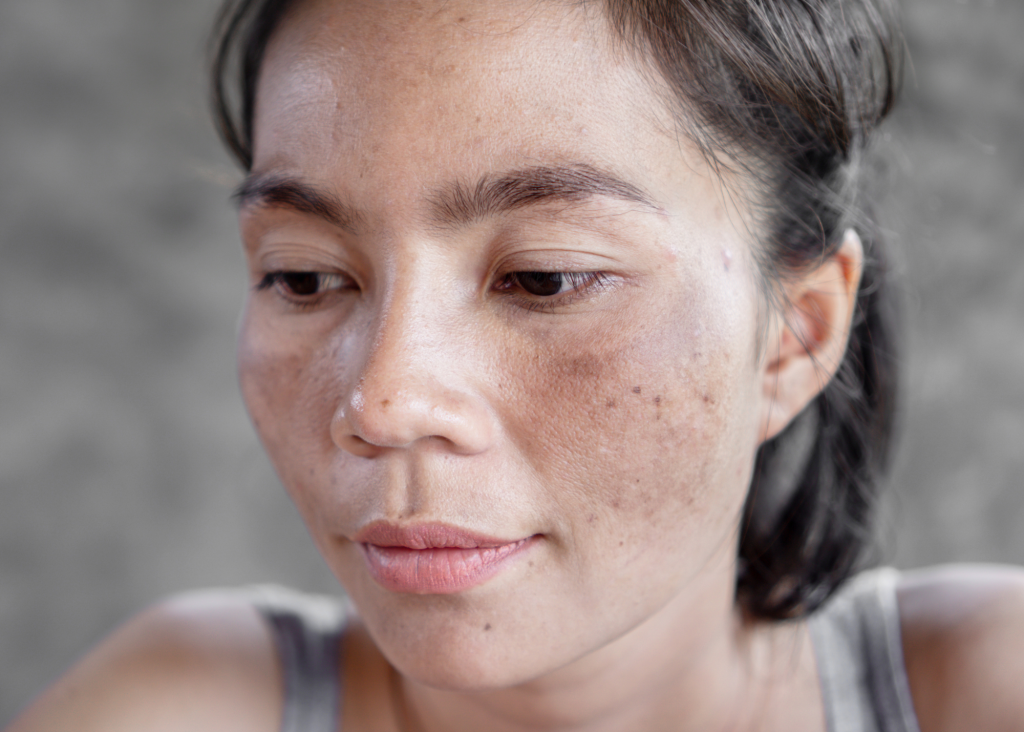 Melasma Skin Condition Treatment | Vancouver Laser Centre