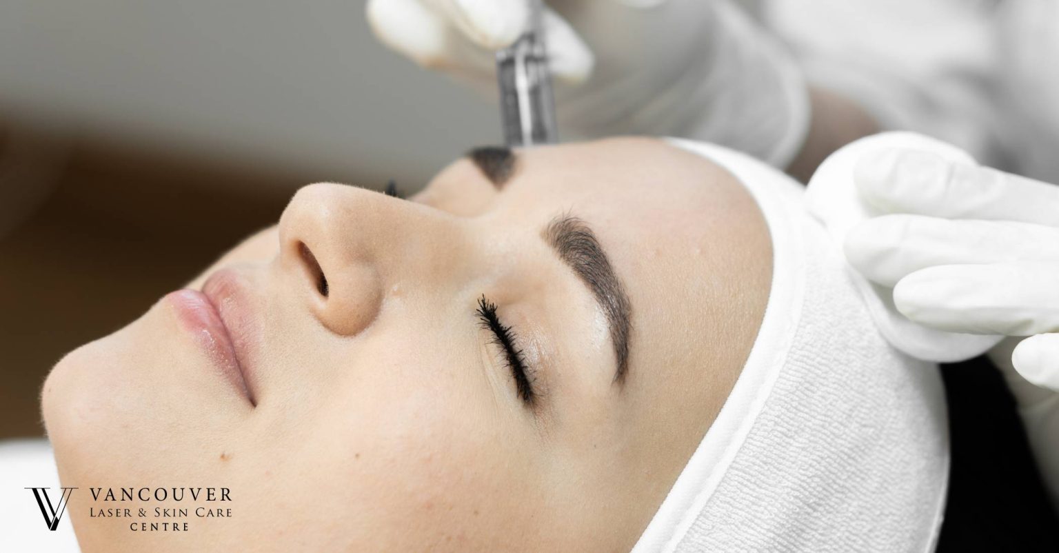 Does Microneedling Hurt? + What to Expect & Pain Tips - Vancouver Laser ...