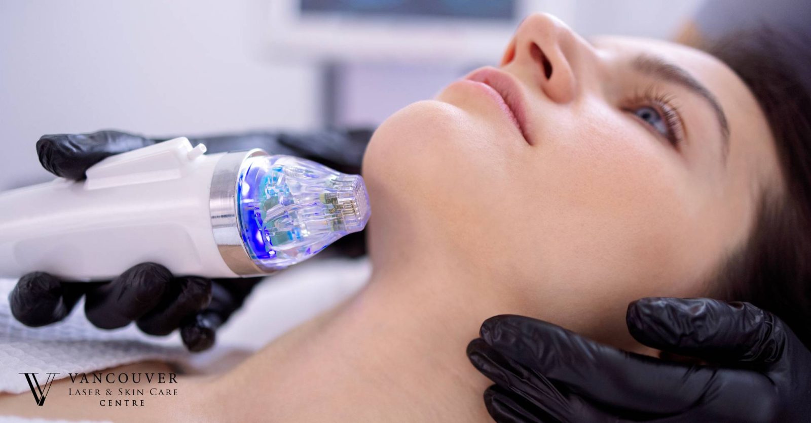 RF Microneedling: A Game-Changer for Skin Renewal - Vancouver Laser ...