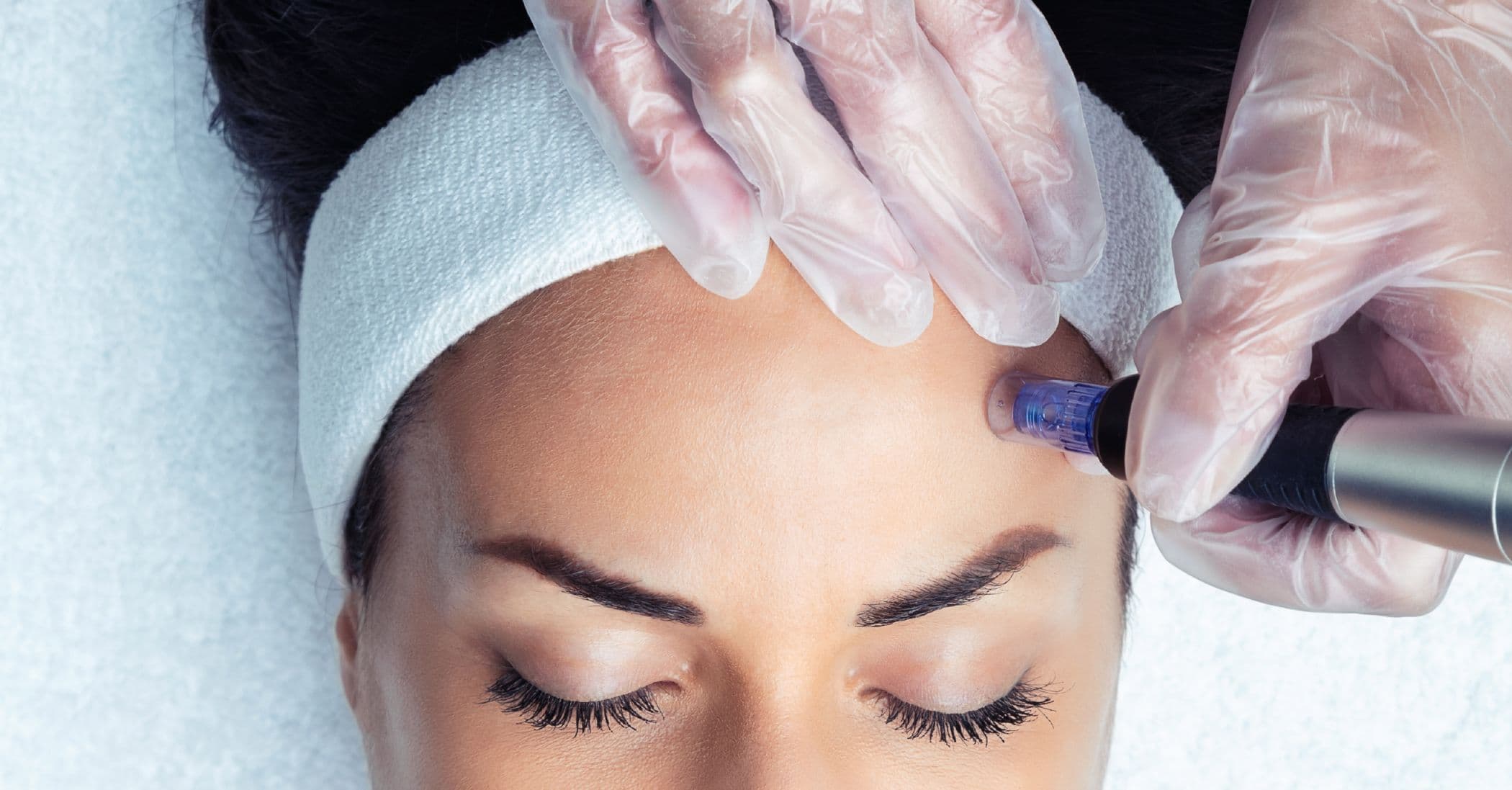 RF Microneedling: A Game-Changer for Skin Renewal - Vancouver Laser ...