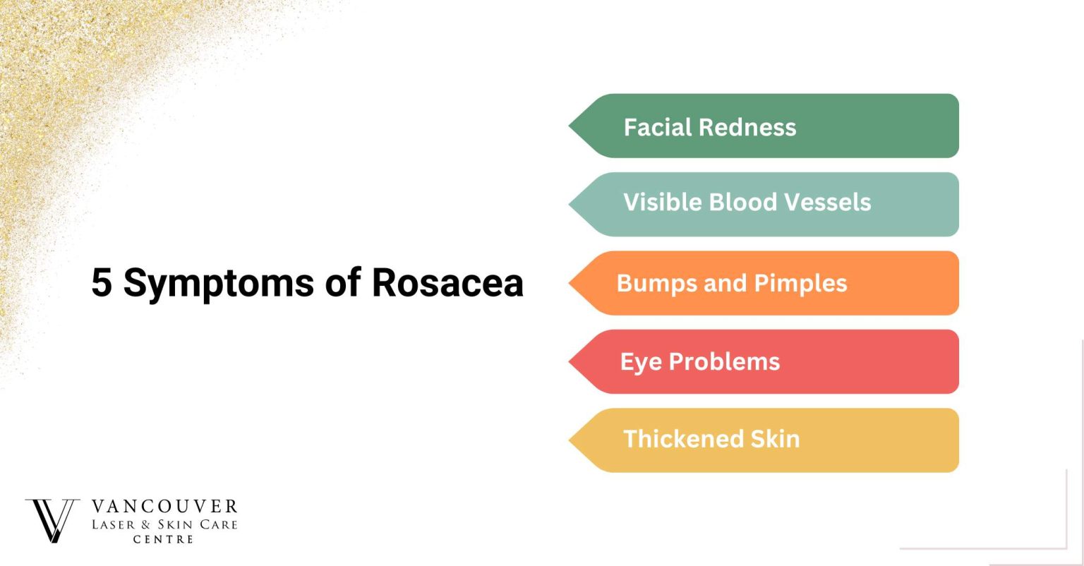 How to Treat Rosacea? (5 Common Symptoms) - Vancouver Laser & Skin Care ...