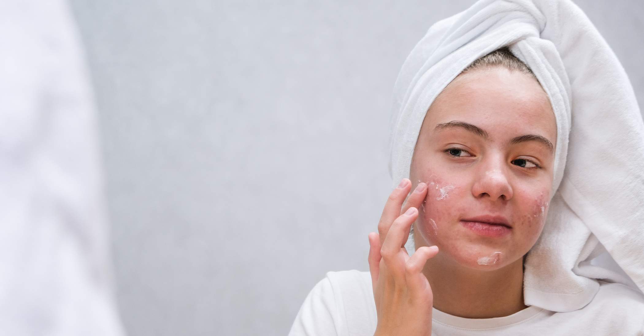 Hormonal Acne: What It Is + How to Treat It Effectively!