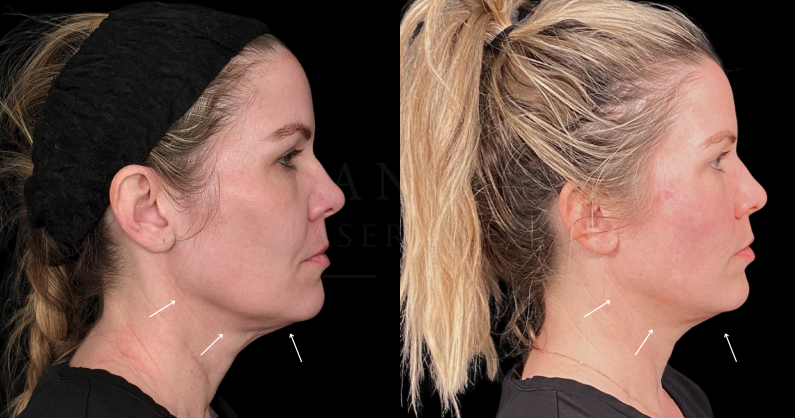 Thread Lift | Aptos Visage Excellence™ at Vancouver Laser